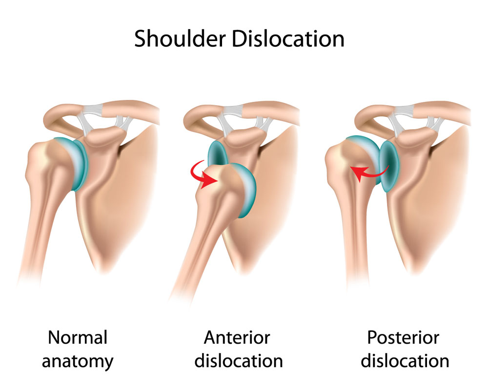 Shoulder Dislocation Shoulder Separation Austin Round Rock Cedar